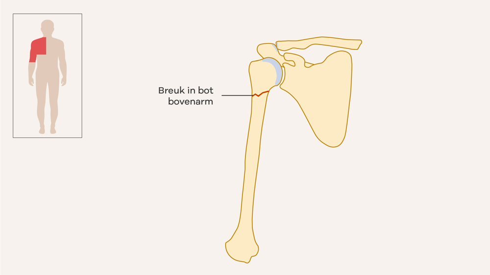 Gebroken bovenarm Gebroken bovenarm